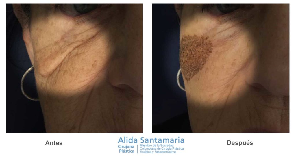 Galería de fotos Tecnología Plexer Cirugía Plasma - Dra Alida ...