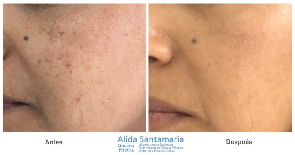 Galería de fotos Tecnología Plexer Cirugía Plasma - Dra Alida ...