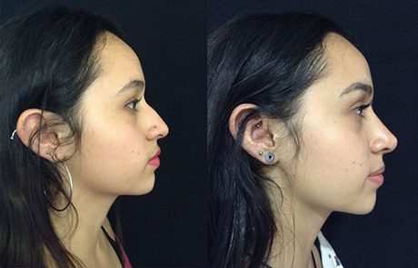 Rinoplastia para nariz ancha, con resultados increíbles | True Doctors